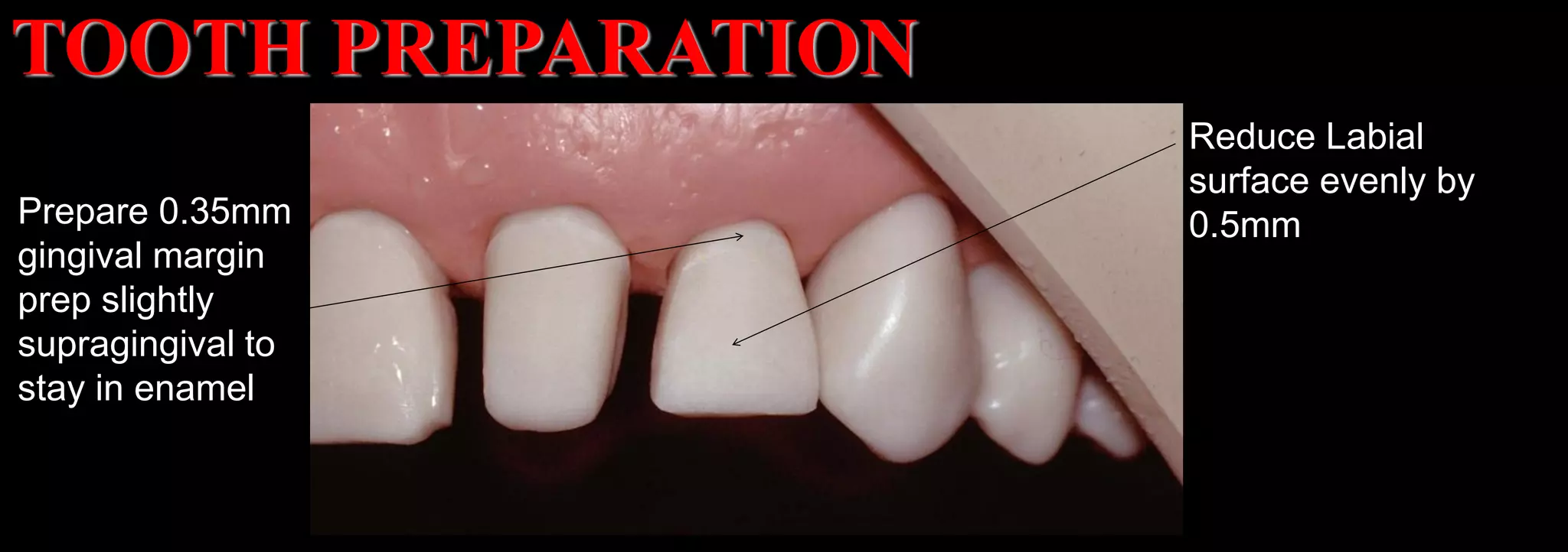 Tooth Preparation - All ceramic crowns | PDF