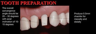 Tooth Preparation - All ceramic crowns | PDF