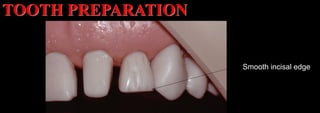 Tooth Preparation - All ceramic crowns | PDF