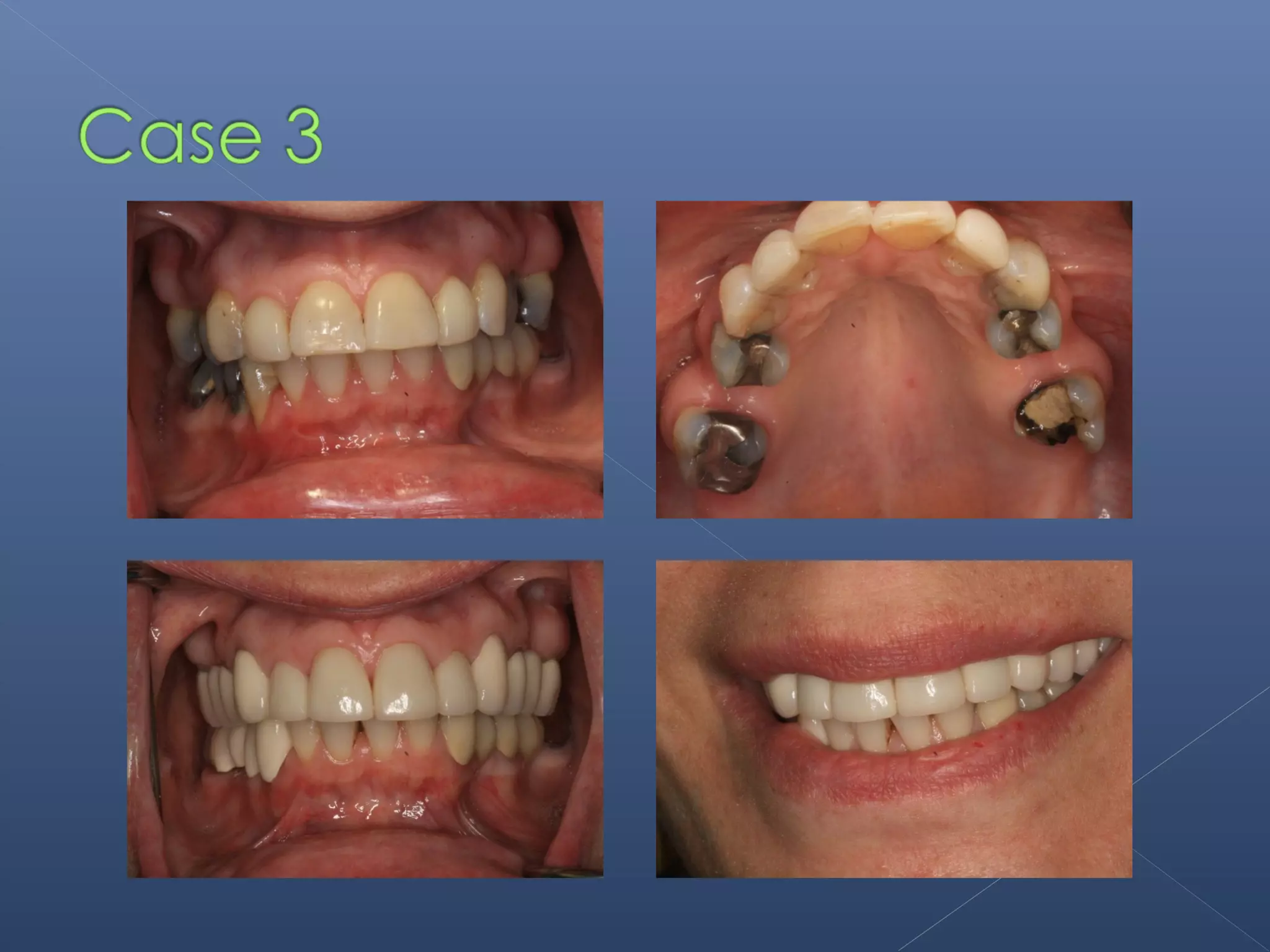 All Ceramic Restorations | PPT