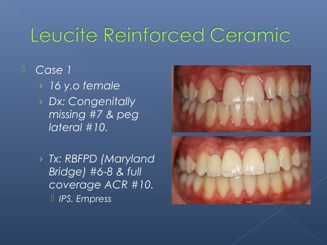 All Ceramic Restorations | PPT | Dental Health | Diseases and Conditions