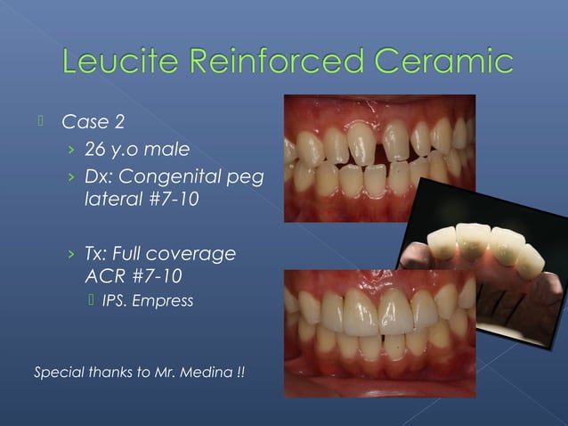 All Ceramic Restorations | PPT | Dental Health | Diseases and Conditions