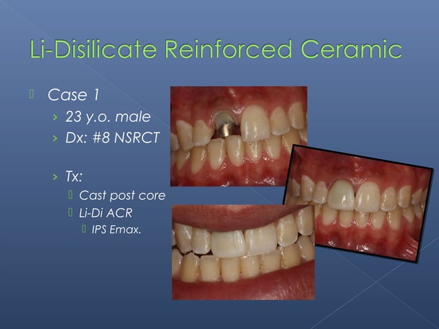 All Ceramic Restorations | PPT | Dental Health | Diseases and Conditions