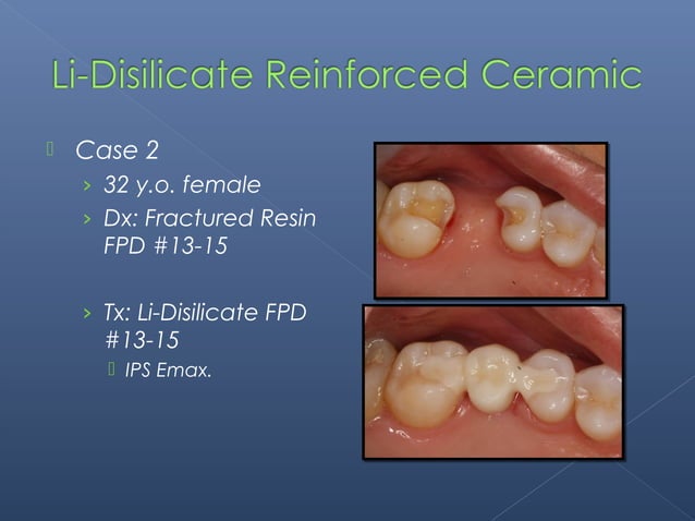 All Ceramic Restorations | PPT | Dental Health | Diseases and Conditions