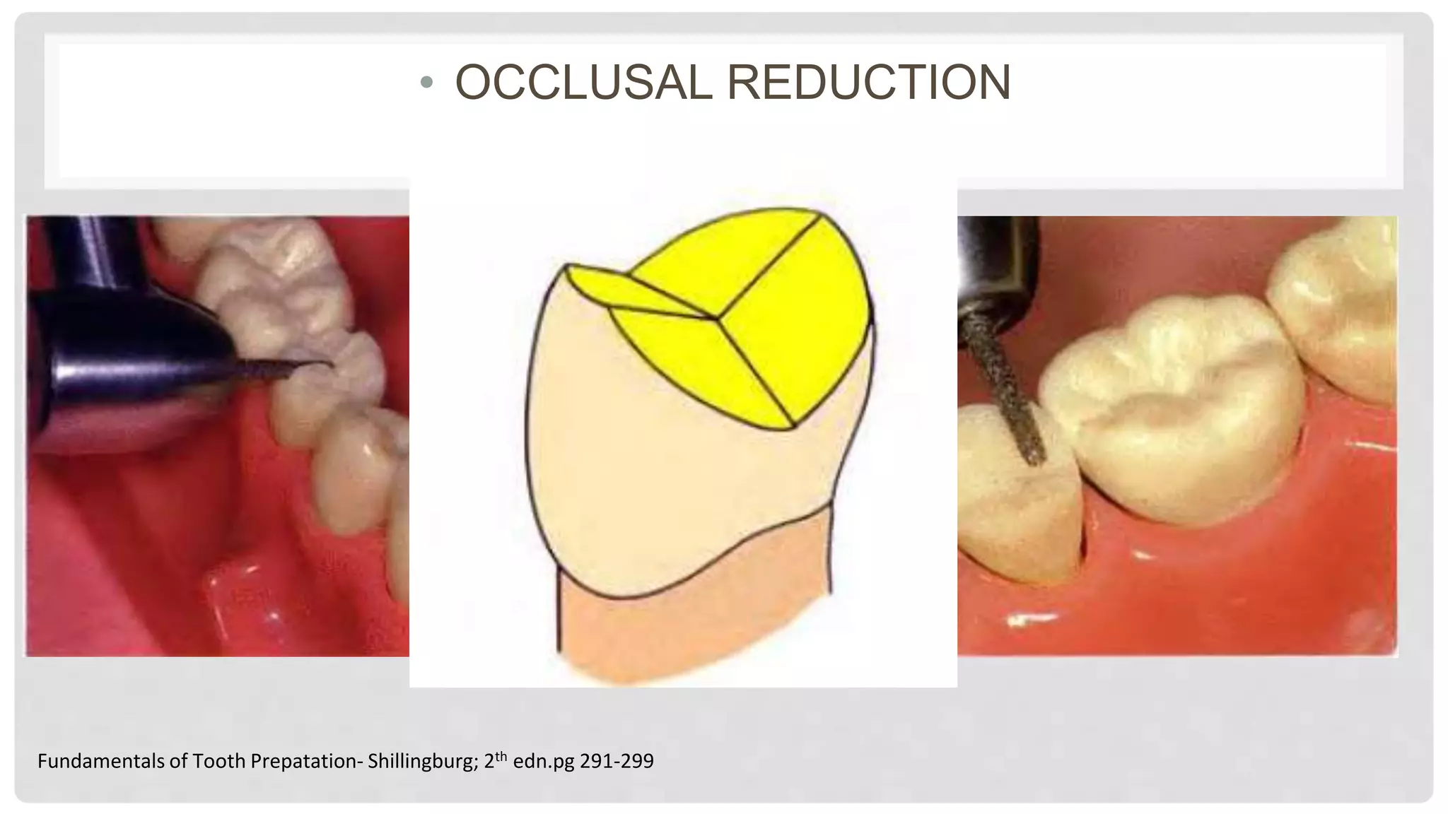 All ceramic restorations | PPTX