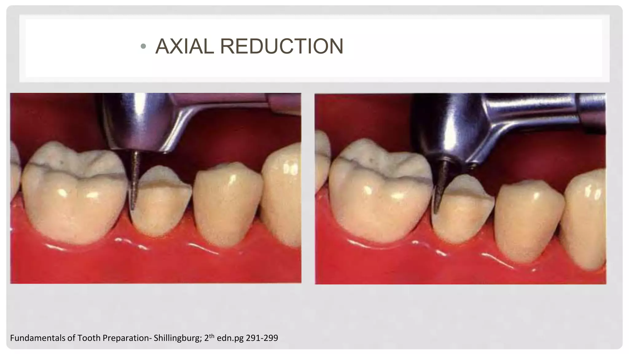All ceramic restorations | PPTX