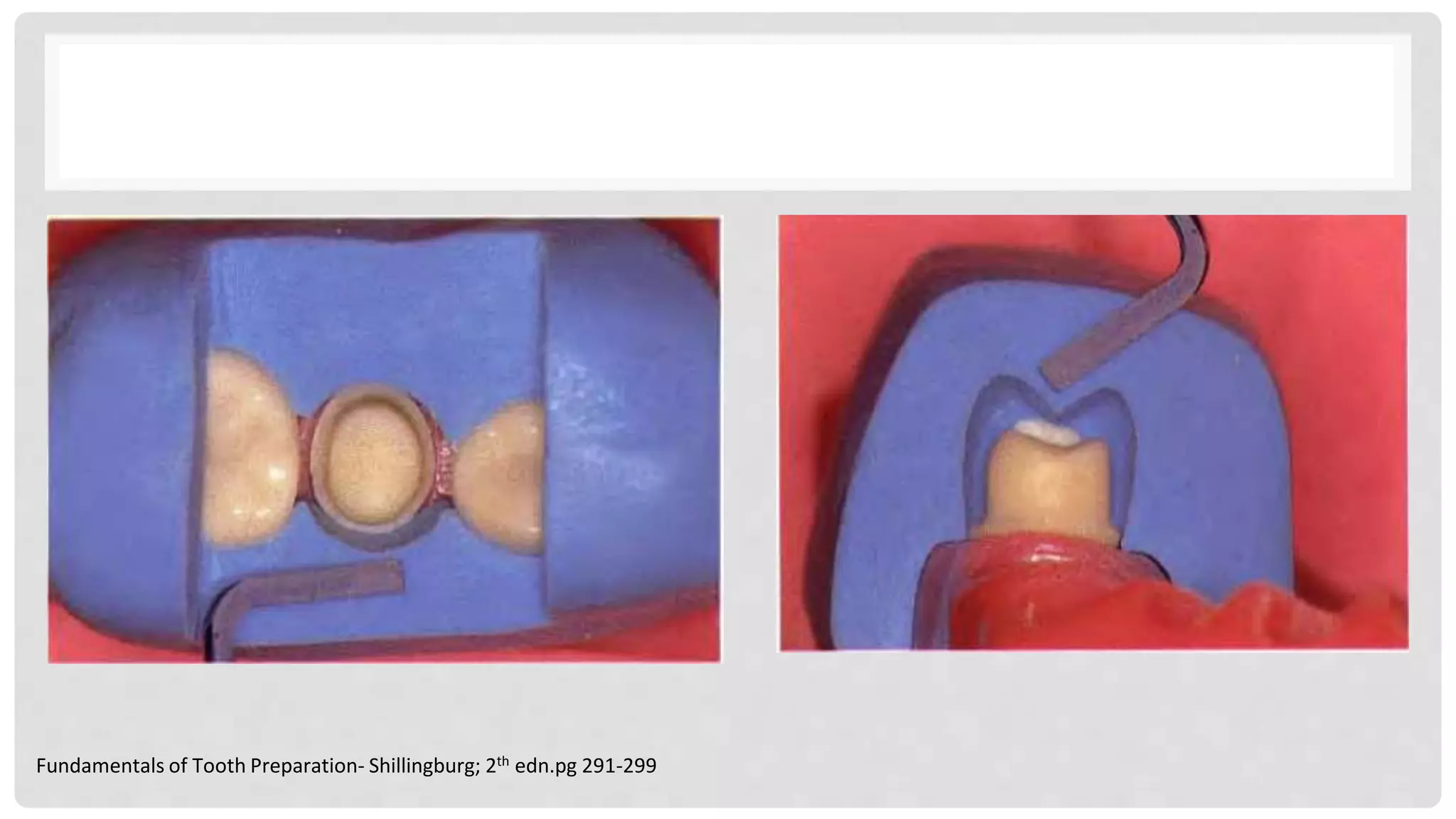 All ceramic restorations | PPTX