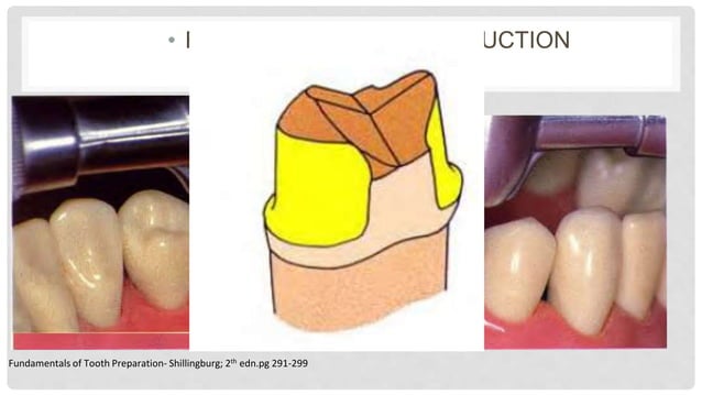 All ceramic restorations | PPTX