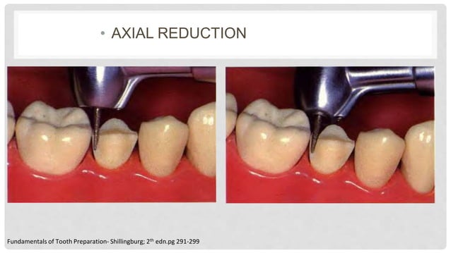 All ceramic restorations | PPTX