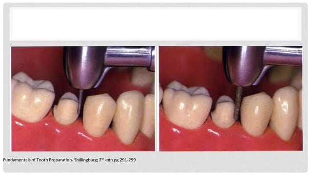 All ceramic restorations | PPTX