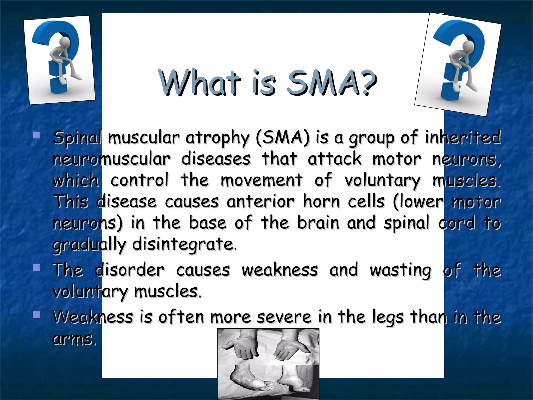 spinal muscular atrophy sma by allelieh | PPT