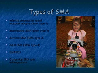 spinal muscular atrophy sma by allelieh | PPT