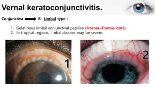 Allergic conjuctivitis | PPTX