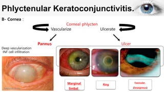 Allergic conjuctivitis | PPTX
