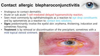 Allergic conjuctivitis | PPT