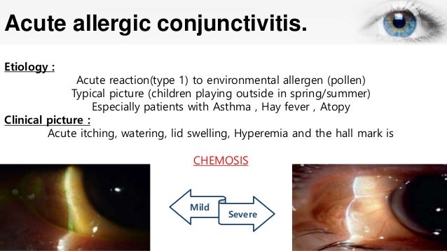 Allergic conjuctivitis
