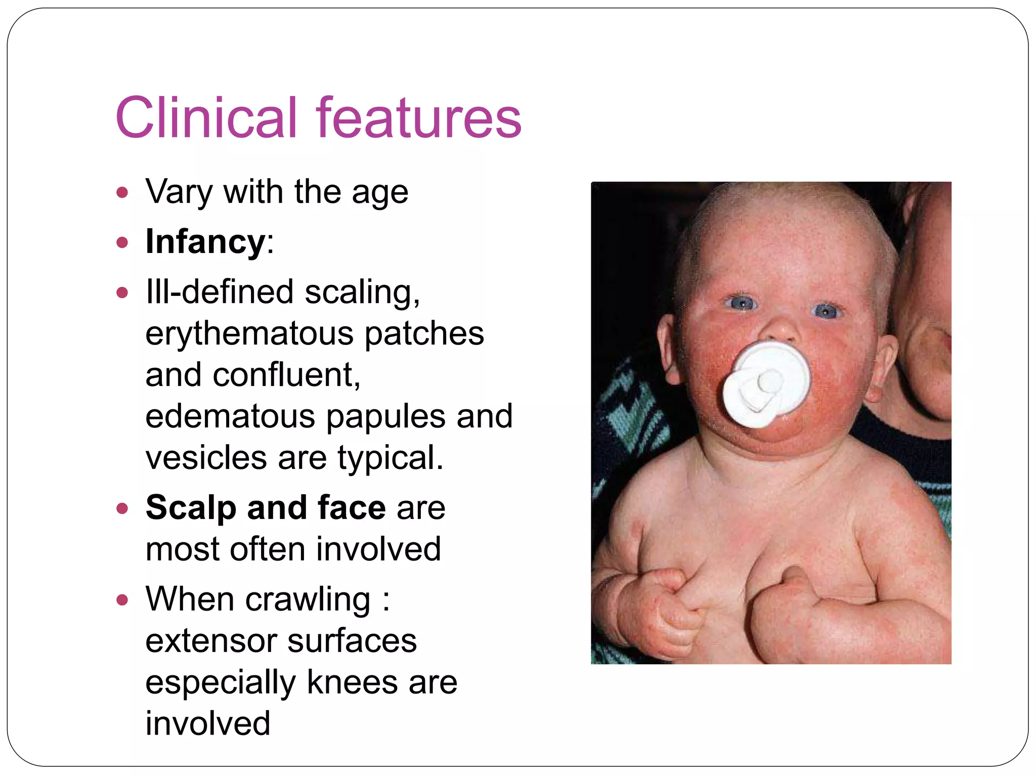 Allergic Disorders In Children | PPTX