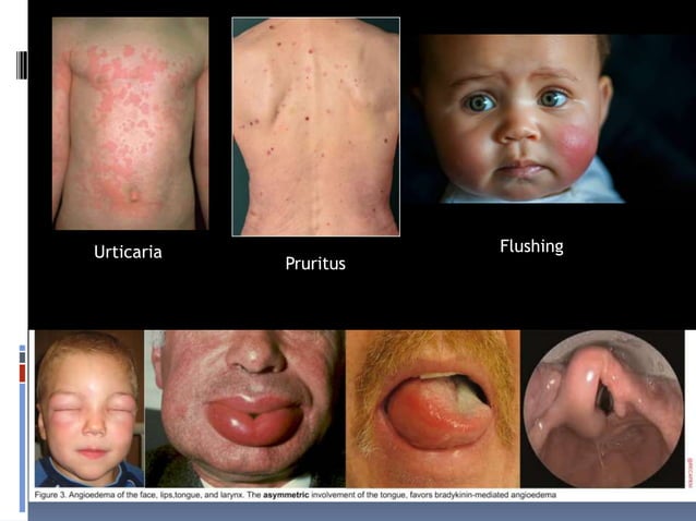 ALLERGIC & anaphylaxis | PPTX | Allergies | Diseases and Conditions