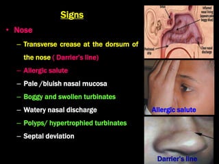 Boggy Nasal Mucosa