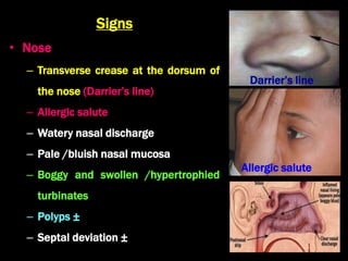 Pale Nasal Turbinates