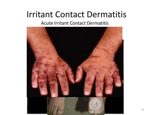 Allergic and irritant contact dermatitis | PPTX | Skin and Dermatology ...