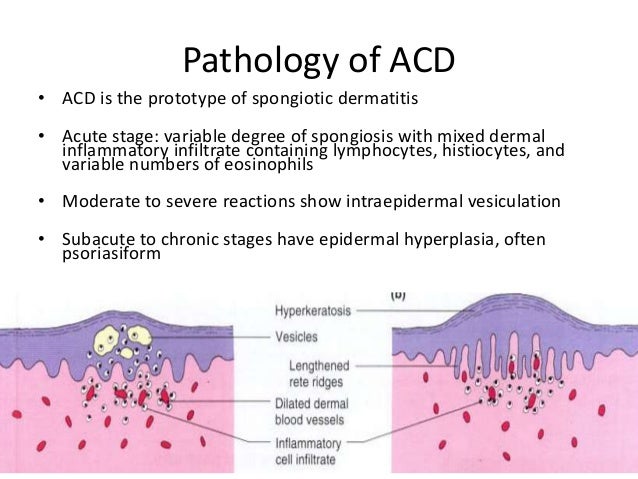 Allergic and irritant contact dermatitis