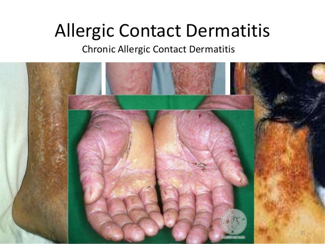 Allergic and irritant contact dermatitis