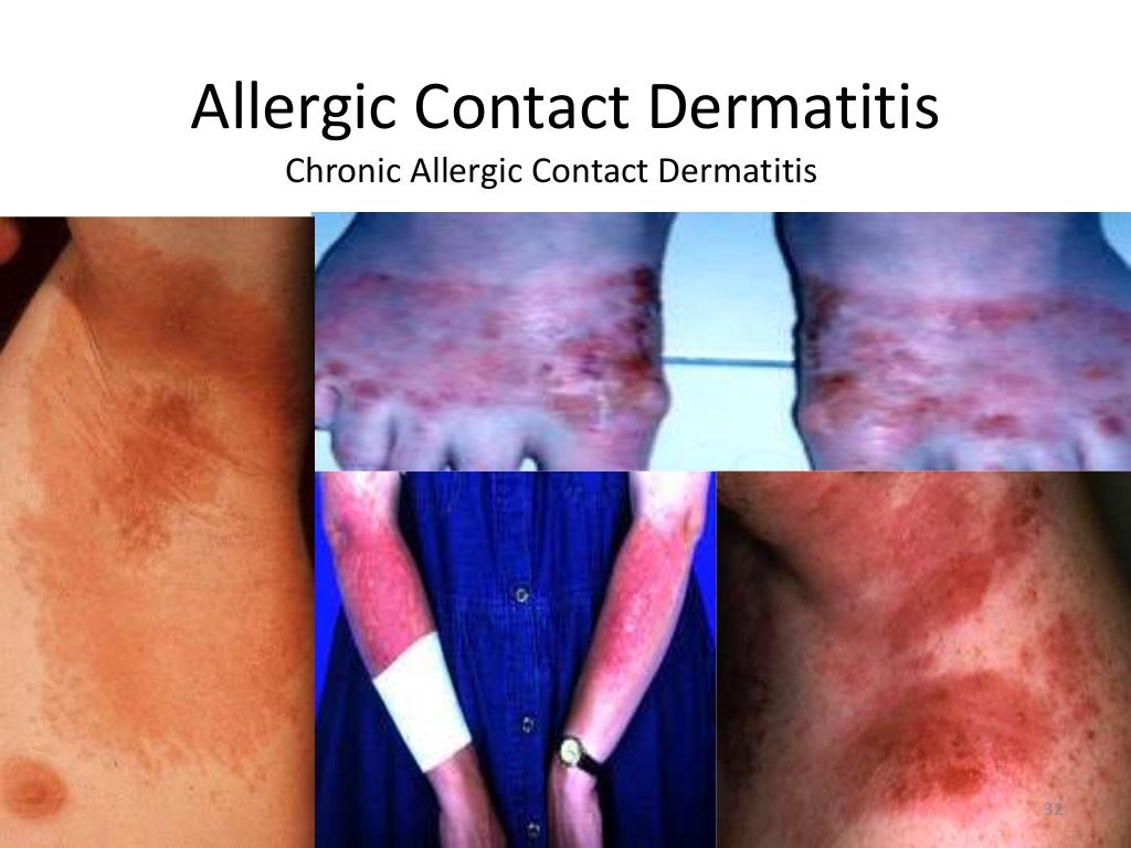 Allergic and irritant contact dermatitis
