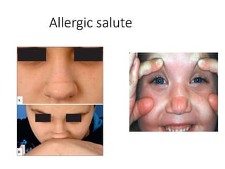 Allergic Salute