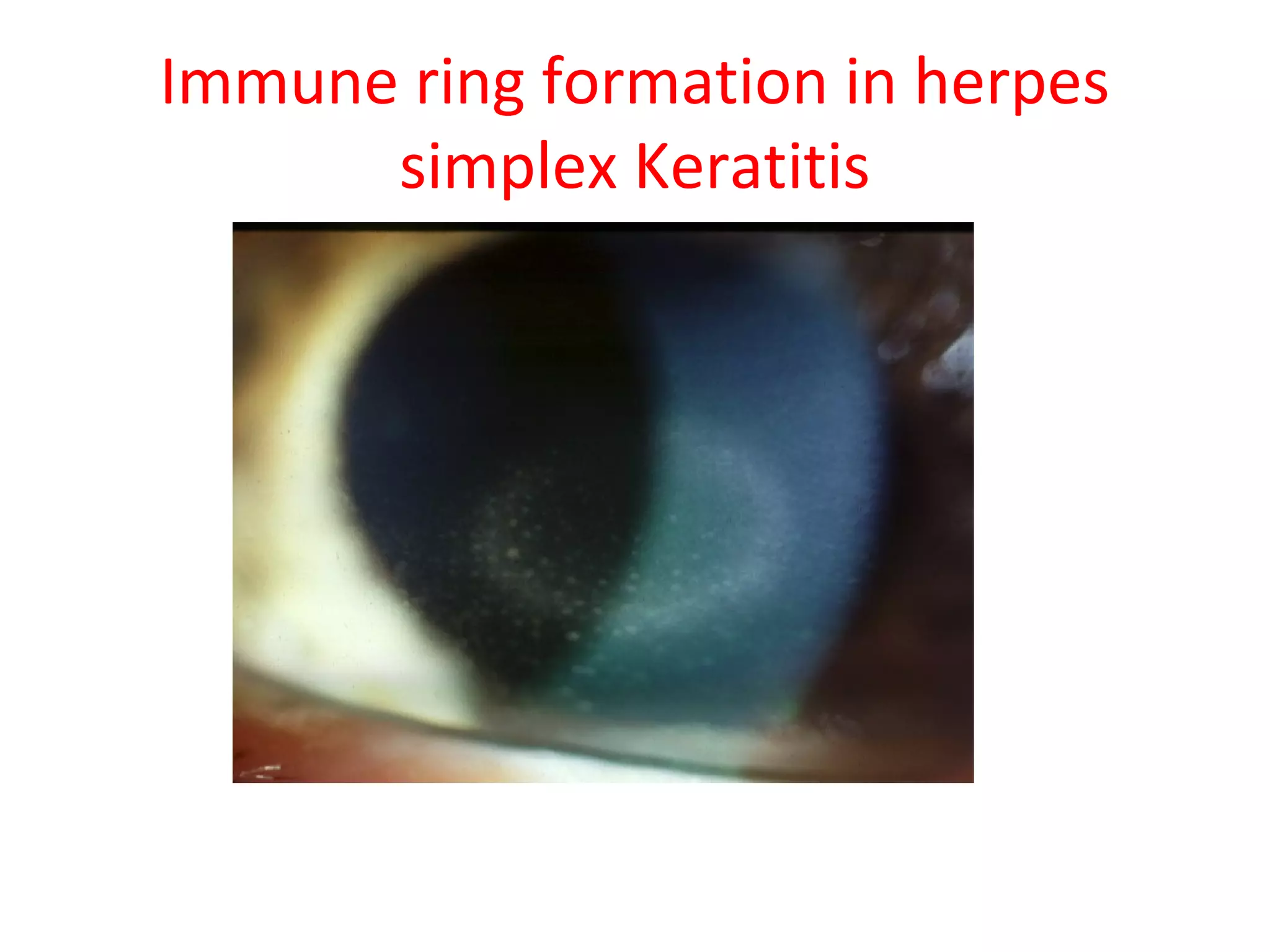ALLERGY AND HYPERSENSITIVITY: PERRENIAL CONJUNCTIVITIS, VERNAL ...