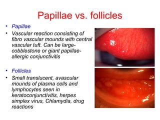 Allergic Conjunctivitis Cobblestone