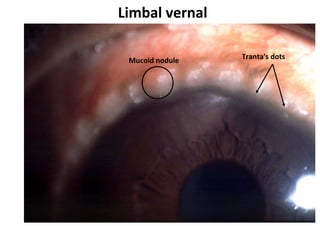 Horner Trantas Spots