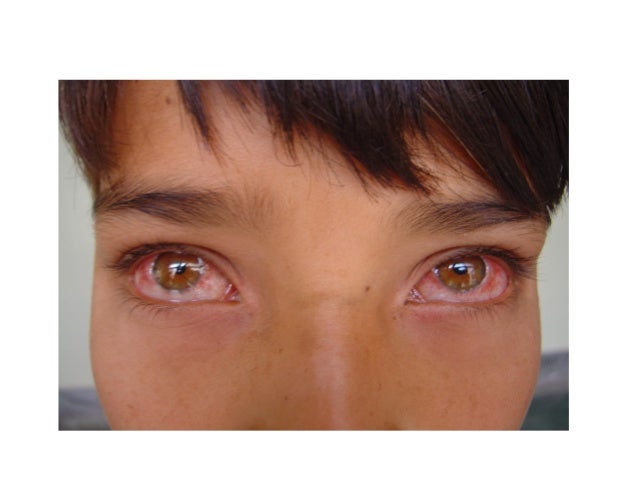ALLERGY AND HYPERSENSITIVITY: PERRENIAL CONJUNCTIVITIS, VERNAL CONJUN…