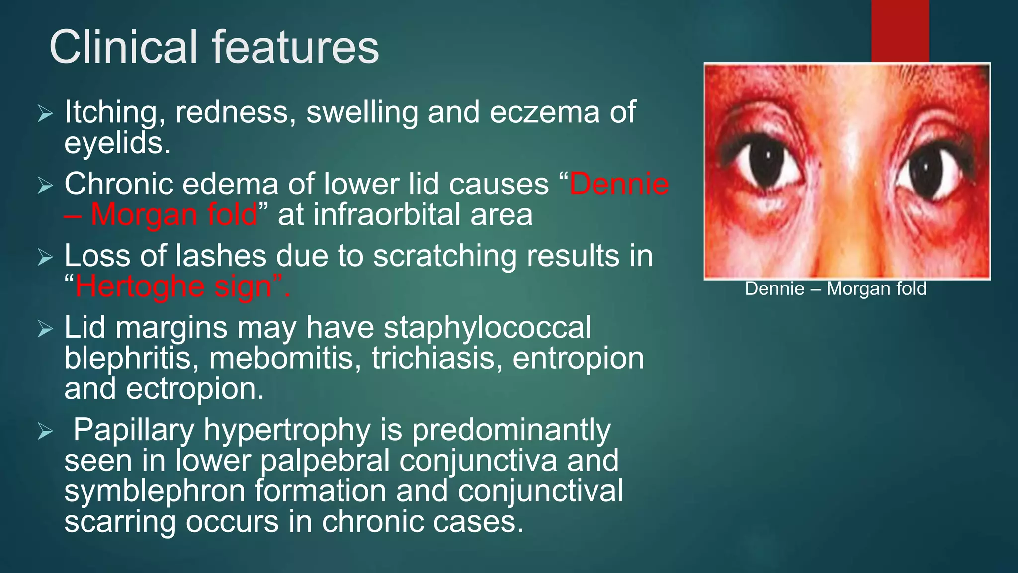 Allergic Conjunctivitis - Dr Arnav Saroya | PPTX