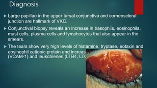 Allergic Conjunctivitis - Dr Arnav Saroya | PPTX