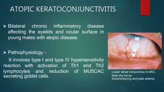 Allergic Conjunctivitis - Dr Arnav Saroya | PPTX