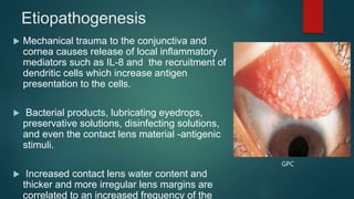 Allergic Conjunctivitis - Dr Arnav Saroya | PPTX