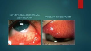 Allergic Conjunctivitis - Dr Arnav Saroya | PPTX