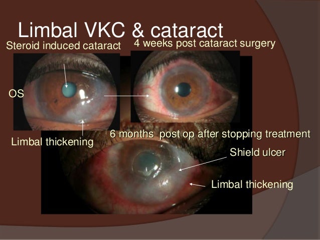 Allergic Conjuncitivitis