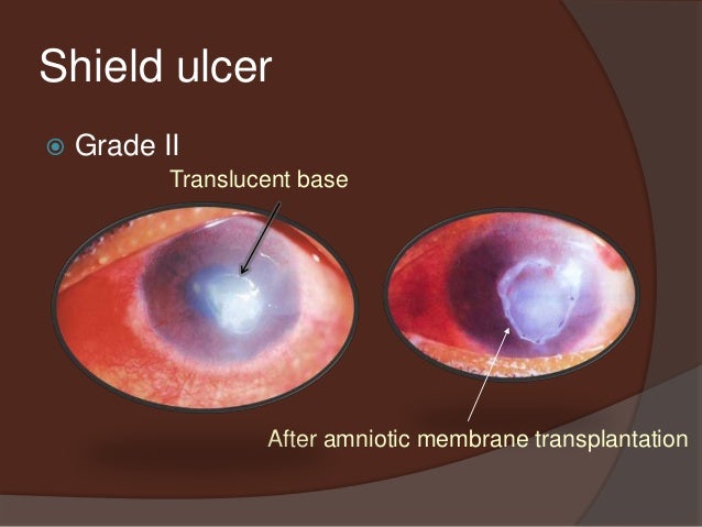 Allergic Conjuncitivitis