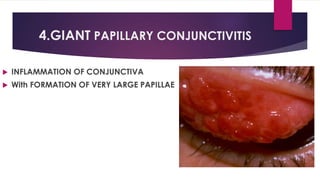 Allergic conjuncticitis | PPTX