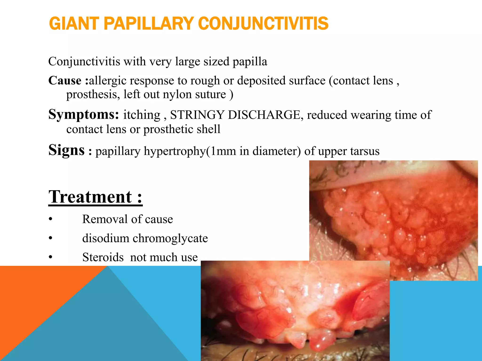 Allergic conjunctivitis | PPTX