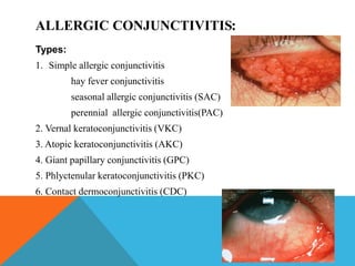 Allergic conjunctivitis | PPTX