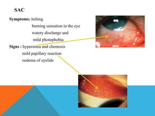 Allergic conjunctivitis | PPTX