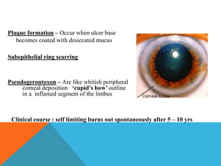 Allergic conjunctivitis | PPT