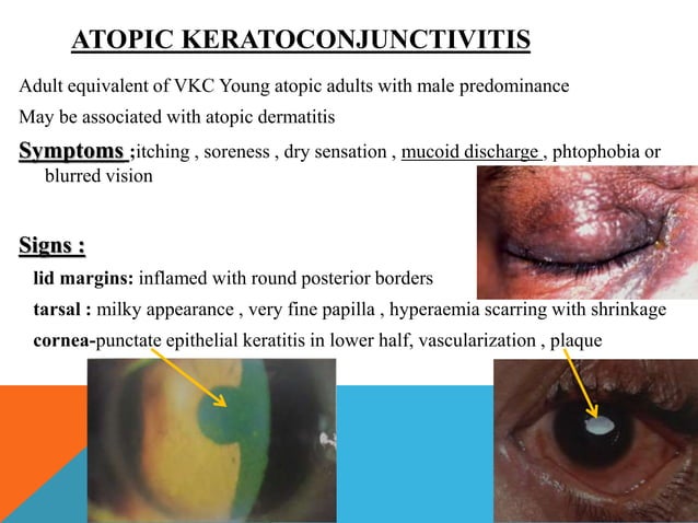 Allergic conjunctivitis | PPT