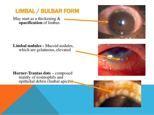 Allergic conjunctivitis