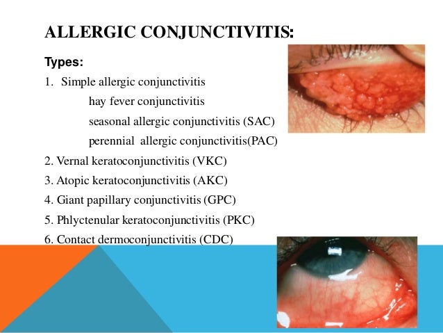 Allergic conjunctivitis