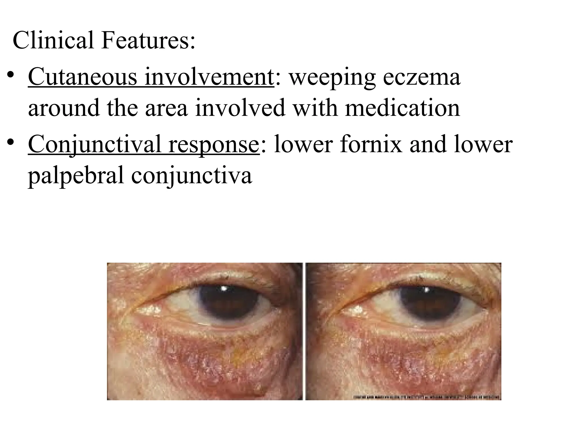 allergicconjunctivitis-150609110928-lva1-app6892.pptx