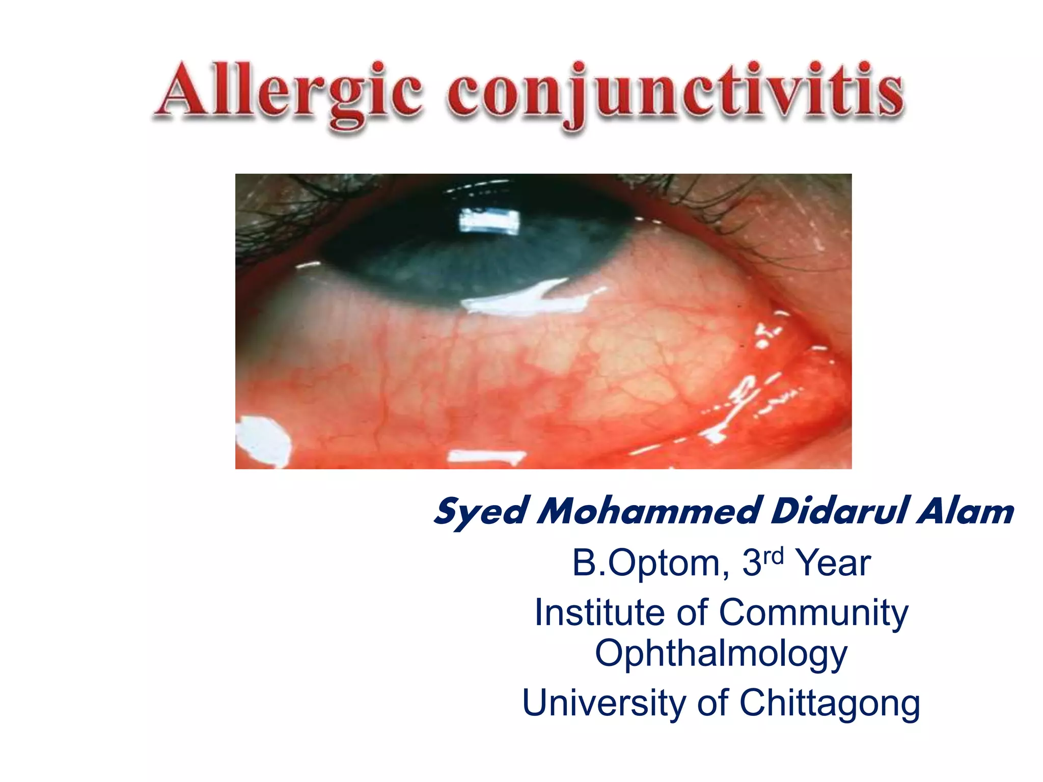 Allergic conjunctivitis | PPTX